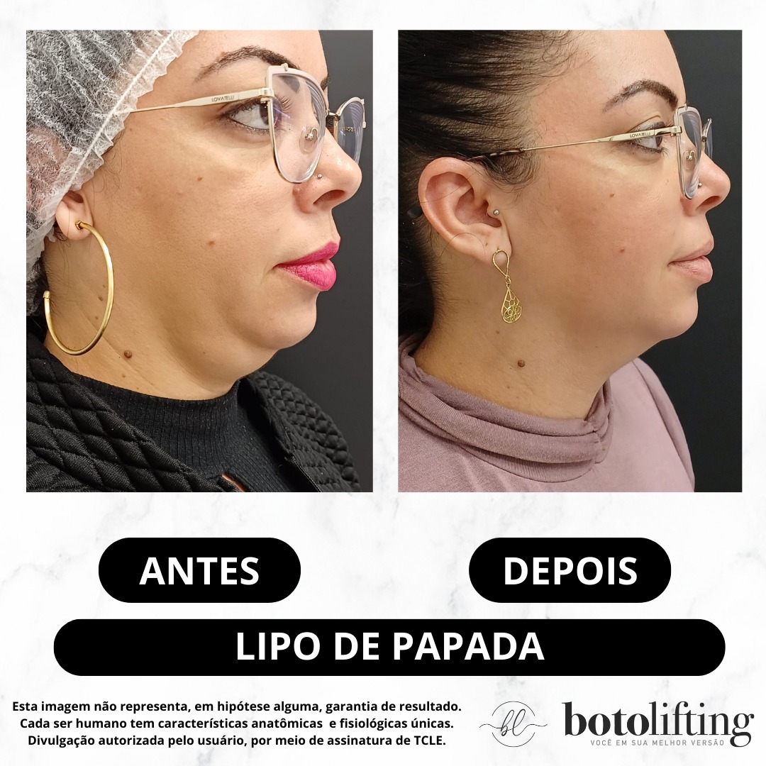 Lipo de Papada - Botolifiting Praia Grande